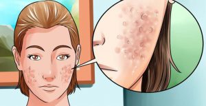 Hyaluronic Acid for Acne Scars Treatments | Stanford Chemicals